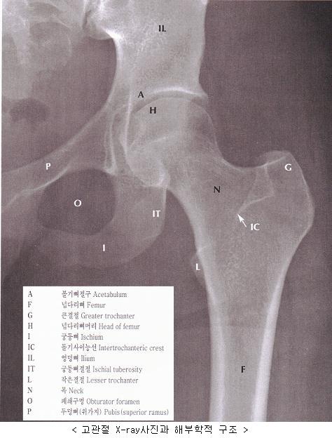 고관절탈구 대퇴골경부골절대퇴골골절대퇴골두무혈성괴사 등의 통증의 대처와 치료 또한 인공고관절과 관절염이란 인공관절병원