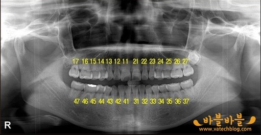 바텍 임상이야기 치아의 번호 및 명칭 바로알기 네이버 블로그