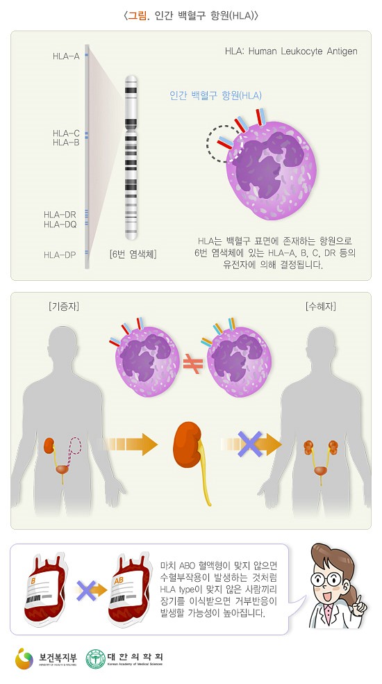 장기이식거부반응 네이버 블로그