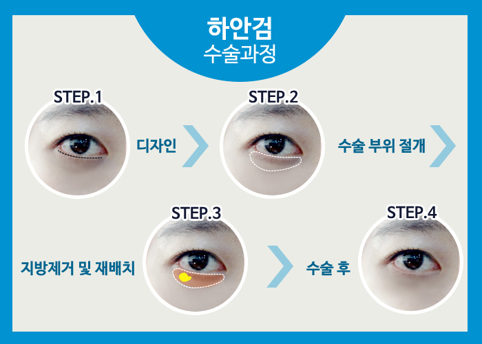 효도성형 상안검수술 하안검수술 가격 비용 이벤트 네이버 블로그