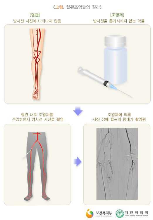 대동맥박리증 증상과 원인 치료방법 네이버 블로그