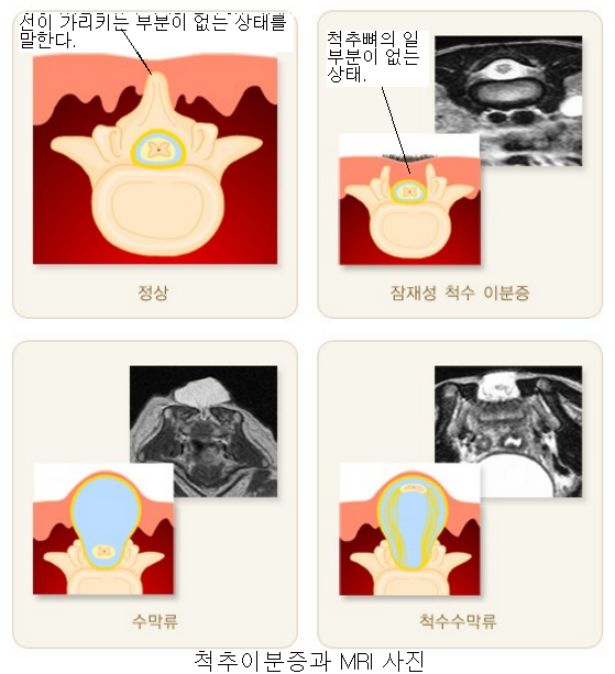 감압수술감압술•미세혈관감압술•척수지주막염지주막염척수거미막염•척추이분증척수이분증척추갈림증•잠재성척수이분증•과잉증•피하