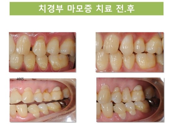 치경부마모증 치아가패였어요 치아가시려요 잇몸이 내려갔어요 네이버 블로그