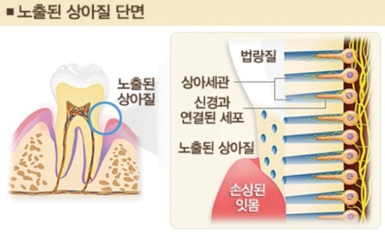 치아 구조와 형태 알아보아요법랑질상아질치수 네이버 블로그