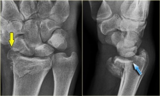원위 요골 골절distal Radius Fracture 중년 여성이 팔을 짚으면서 넘어지면서 손목 통증이 생겼어요