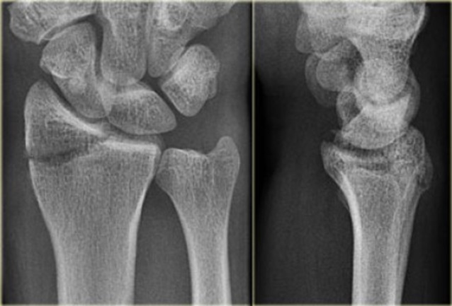 원위 요골 골절distal Radius Fracture 중년 여성이 팔을 짚으면서 넘어지면서 손목 통증이 생겼어요