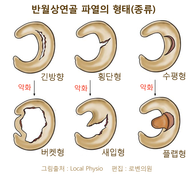 반월상연골파열 비수술 신속 치료 병원 네이버 블로그