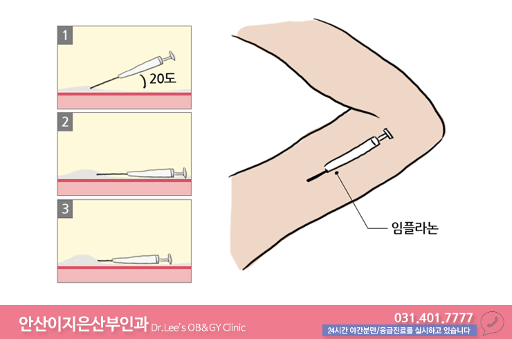 팔에하는 피임 임플라논 효과 및 부작용 네이버 블로그