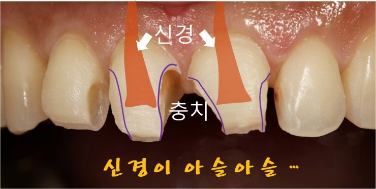 압구정 앞니치료전문치과 죽은 앞니의 뿌리염증 신경치료 재치료 재신경치료 네이버 블로그
