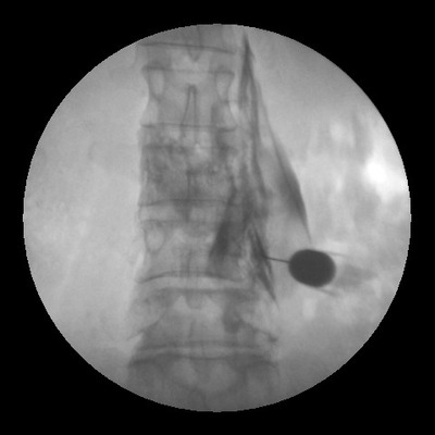 Psoas Compartment Block : 네이버 블로그