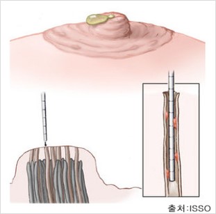 Microdochectomy (미세유관절제술)? : 네이버 블로그