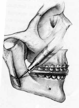 SSRO / IVRO : 네이버 블로그