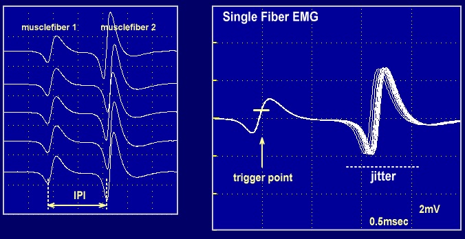 근전도 EMG Electromyograph - Single Fiber EMG : 네이버 블로그
