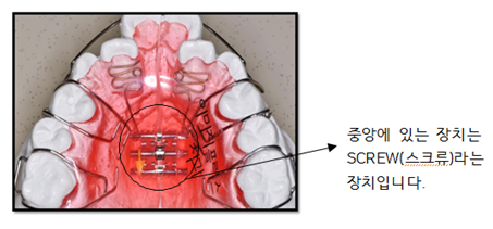 이플과 함께 알아보는 가철성 장치 ACTIVE PLATE(액티브 플레이트) 교정장치 : 네이버 블로그