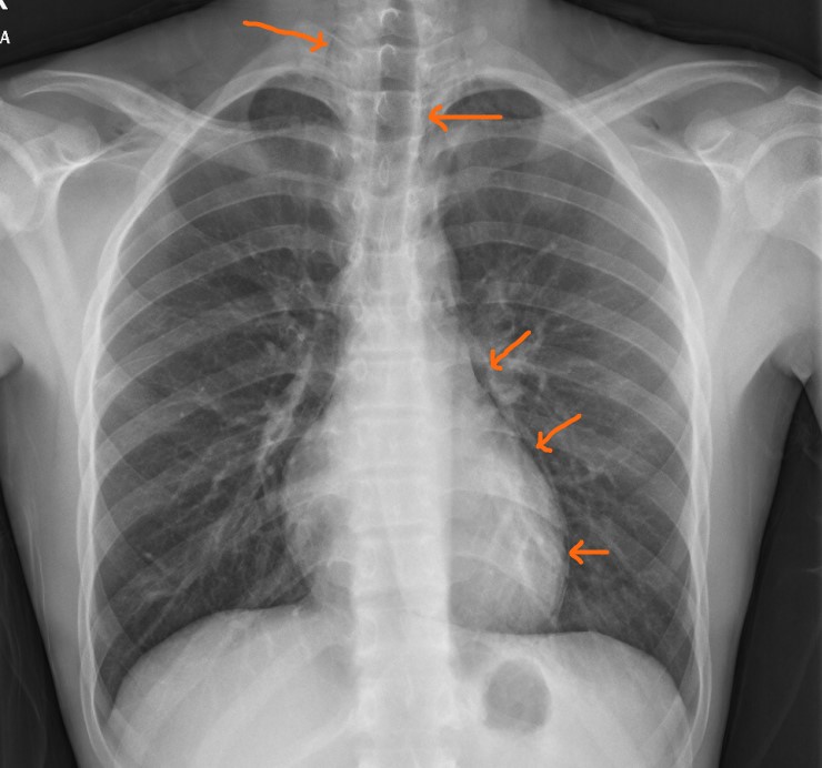 Pneumomediastinum의 원인으로서 ``occult,'' benign perforation of the ...