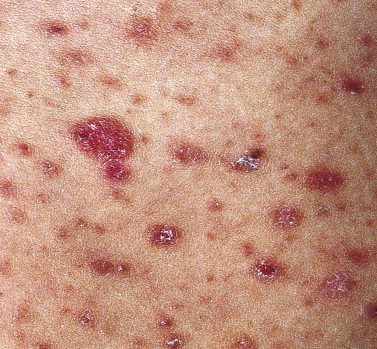 Pityriasis lichenoides et varioliformis acuta(PLEVA),급성 두창 태선 모양 잔비늘증 ...