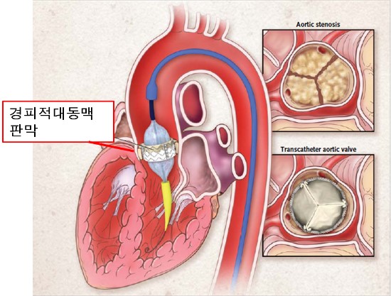 경피적 대동맥판막 치환술(Transcatheter Aortic Valve Implantation[TAVI]) 이란? : 네이버 블로그