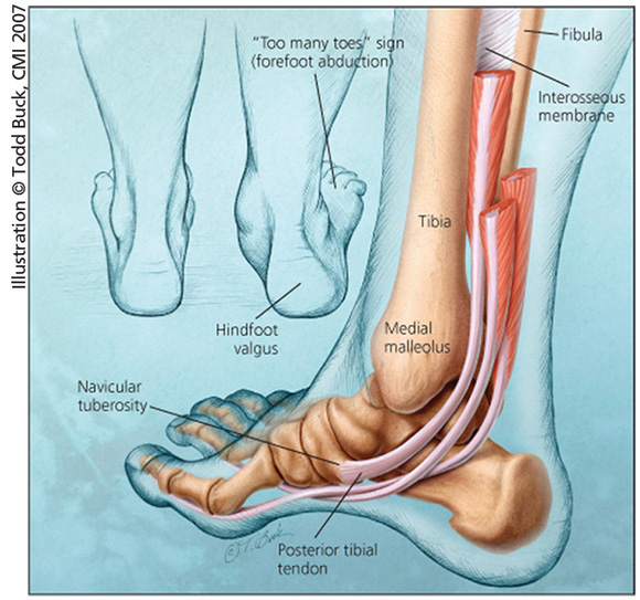 후경골근 기능부전 및 파열((Posterior Tibial Tendonitis / Rupture Syndrome) : 네이버 블로그