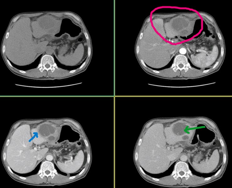 Liver abscess by CT : 네이버 블로그
