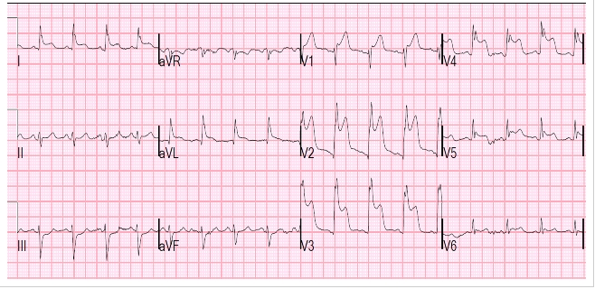 Extensive anterior STEMI ♣ : 네이버 블로그