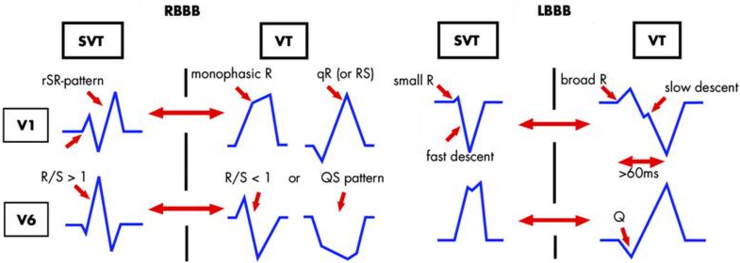 Brugada Criteria : 네이버 블로그