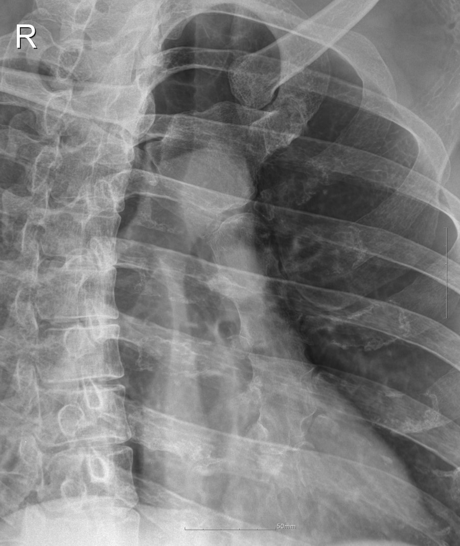 part1.Chest 방사선검사메뉴얼 : 네이버 블로그