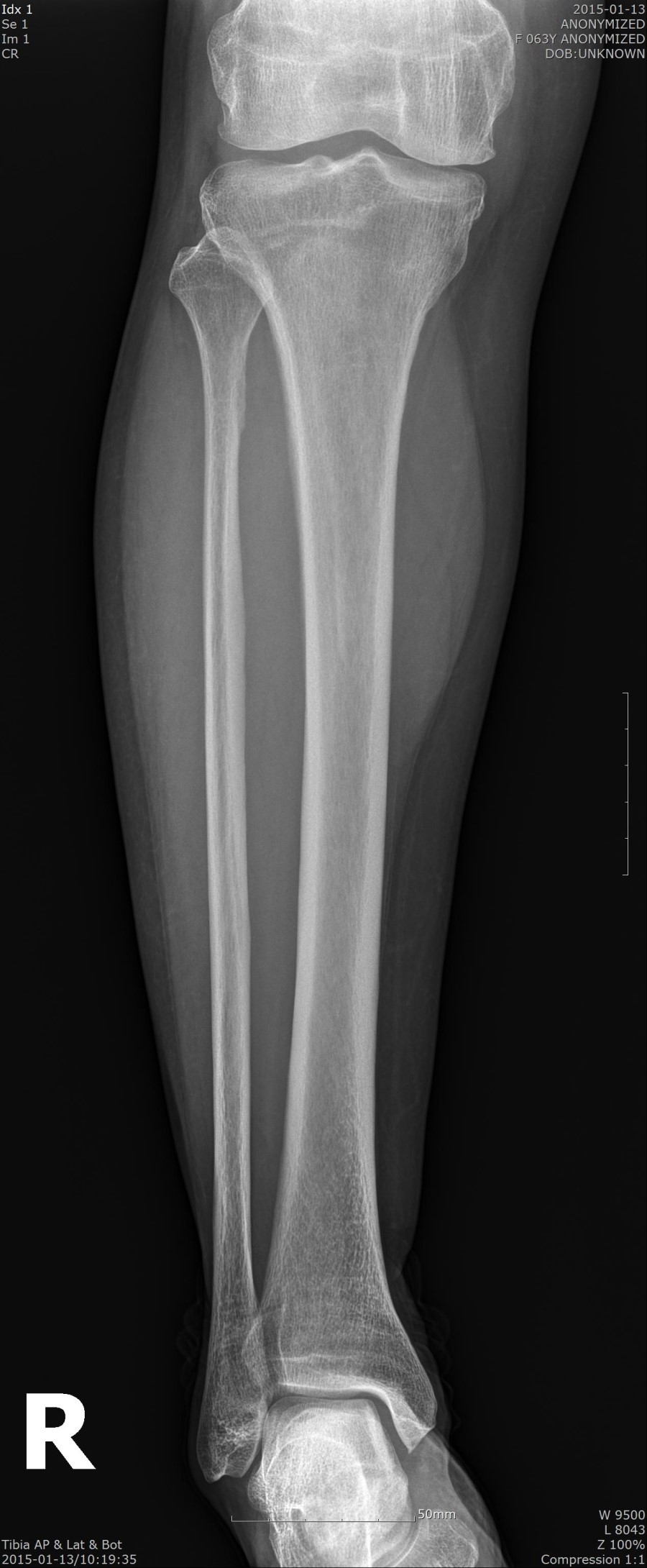part6. Lower extremity 방사선검사메뉴얼 : 네이버 블로그