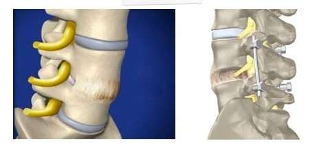 PLIF vs PLF : 네이버 블로그