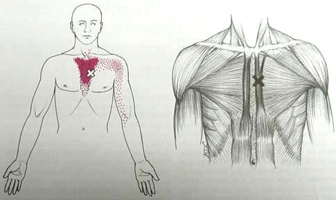흉골근 증후군 - Sternalis syndrome : 네이버 블로그