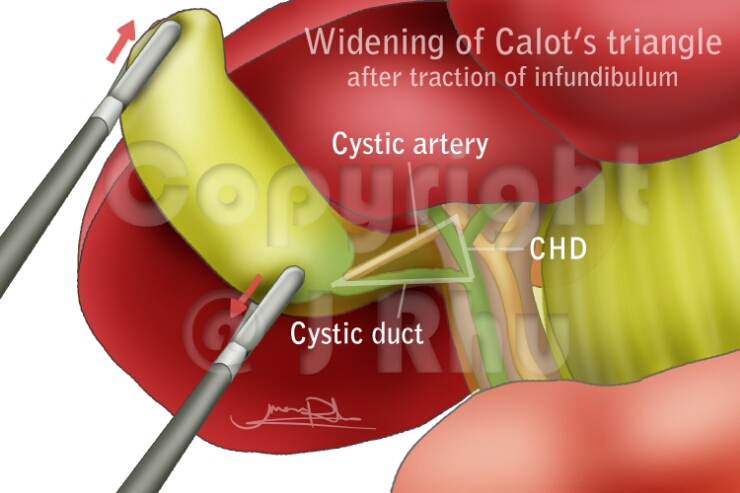 메디컬일러스트 그리닥 : Calot삼각과 담낭절제삼각 Triangle of Calot and hepatocystic ...