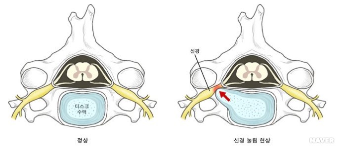 Upper limb tension test: ULTT(Elvey's test) : 네이버 블로그