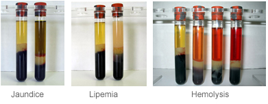 빌리루빈(bilirubin) 대사과정과 검사결과 해석 - 황달 : 네이버 블로그