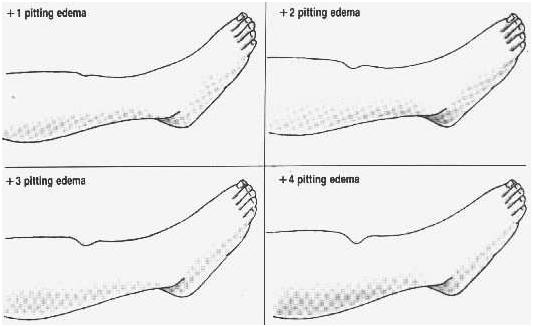 Pitting Edema 함요성 부종 : 네이버 블로그