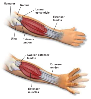 Lateral epicondylitis test : 네이버 블로그