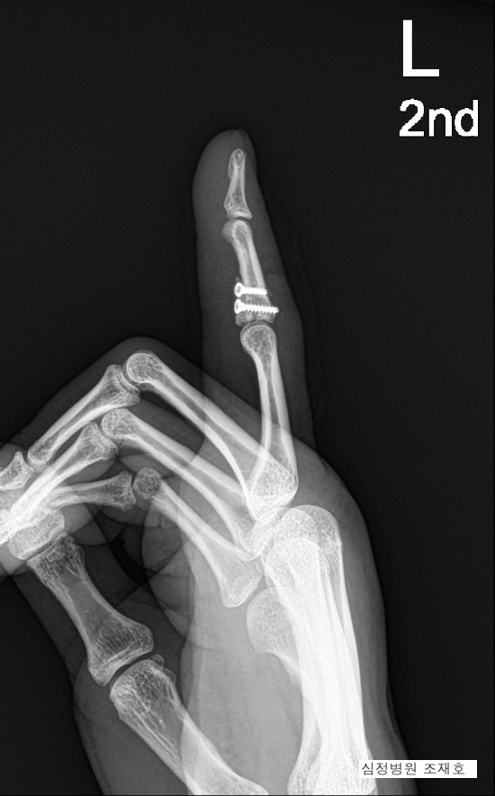 우리 몸의 관절이야기 by Dr.조재호: 손가락의 근위지 관절 골절 탈구에서의 관혈적 정복술 및 내고정술(ORIF at ...