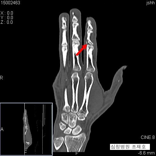우리 몸의 관절이야기 by Dr.조재호: 손가락의 근위지 관절 골절 탈구에서의 관혈적 정복술 및 내고정술(ORIF at ...
