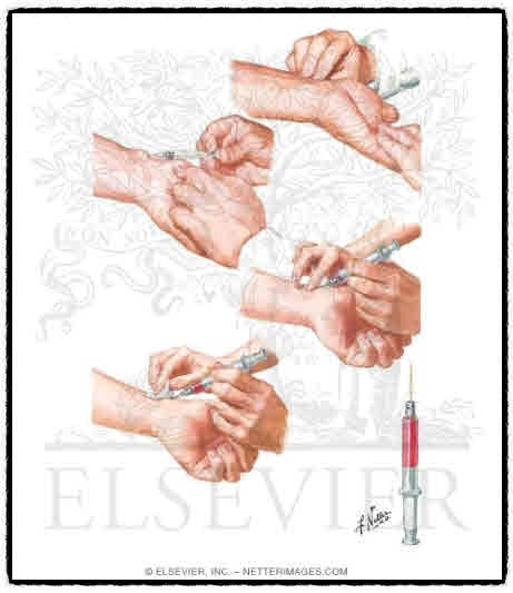 [의대생 실습] ABGA(동맥혈 가스 분석 검사) : 네이버 블로그