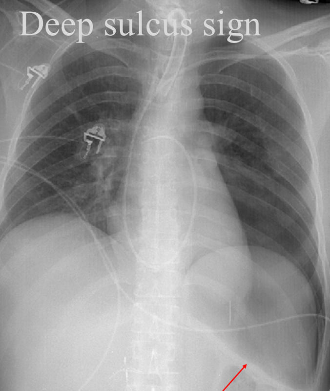 가슴엑스레이 이상소견들, Continuous diaphragm sign, Deep sulcus sign, Fallen Lung ...