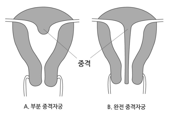 쌍각자궁, 중격자궁, 중복자궁, 단각자궁 등 자궁기형은 임신가능? : 네이버 블로그