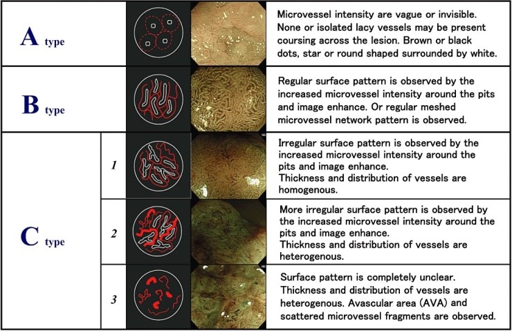 Narrow band imaging (NBI) magnifying classification for colon tumors ...
