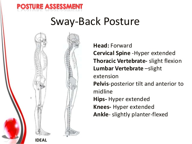 굽은 등 Sway back 교정법에 대해서 알아 봅시다. : 네이버 블로그