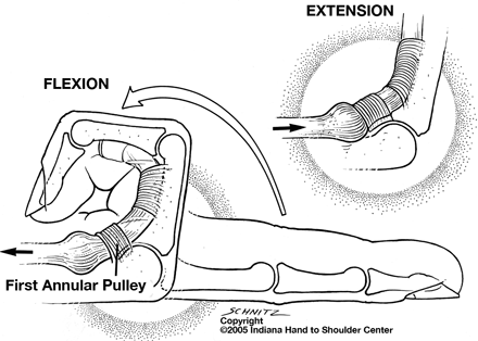 탄발지(방아쇠수지)/손가락 건초염/손가락통증 증상과 원인, 치료법/약수경희한의원 : 네이버 블로그