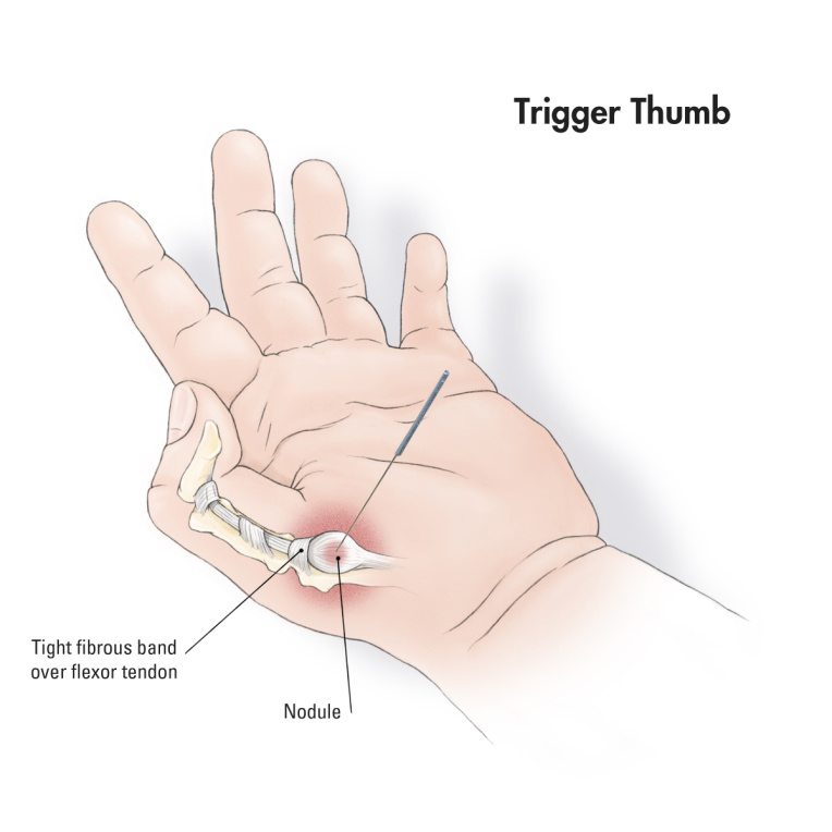탄발지(방아쇠수지)/손가락 건초염/손가락통증 증상과 원인, 치료법/약수경희한의원 : 네이버 블로그