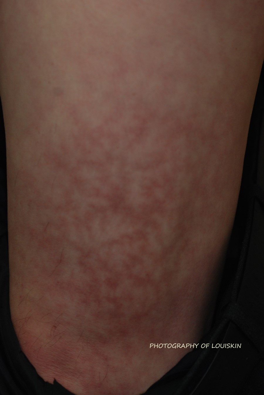 열성 홍반 (Erythema ab igne) 에 대한 기억 : 네이버 블로그