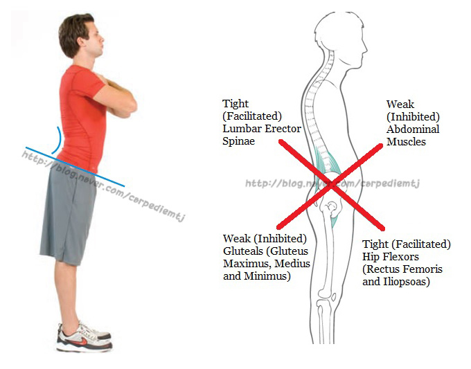 하지교차증후군(Lower crossed syndrome) [서교동pt,체형교정,케틀벨] : 네이버 블로그