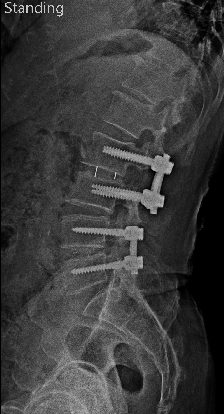 신경외과 수술 2편 척추체유합술 TLIF/PLIF : 네이버 블로그