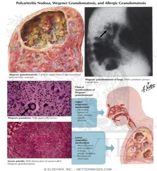 granulomatosis with polyangitis (GPA) - Wegener's granulomatosis : 네이버 블로그
