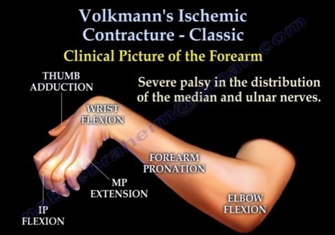 볼크만 허혈성 구축(Volkmann's ischemic contracture) : 기브스를 하고 난 뒤에 팔이 아프고 손이 굽혀 ...