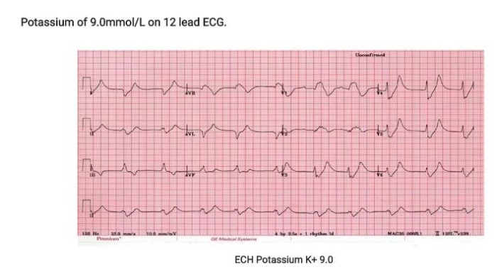 Hyperkalemia, EKG (3) : 네이버 블로그