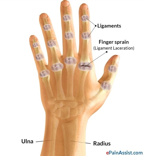 엄지 중수-수지 관절 탈구 및 인대 손상(1st MCP joint dislocation vand ligament injury ...